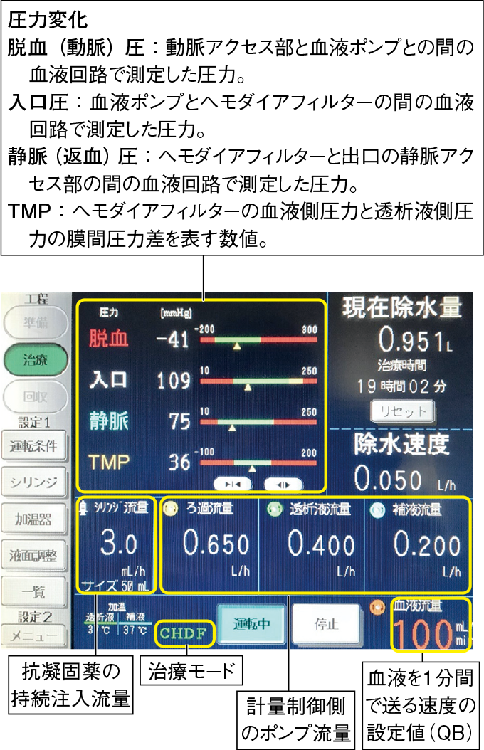 持続的血液濾過透析（CHDF）| ICUでの血液浄化療法 | 看護roo![カンゴルー]