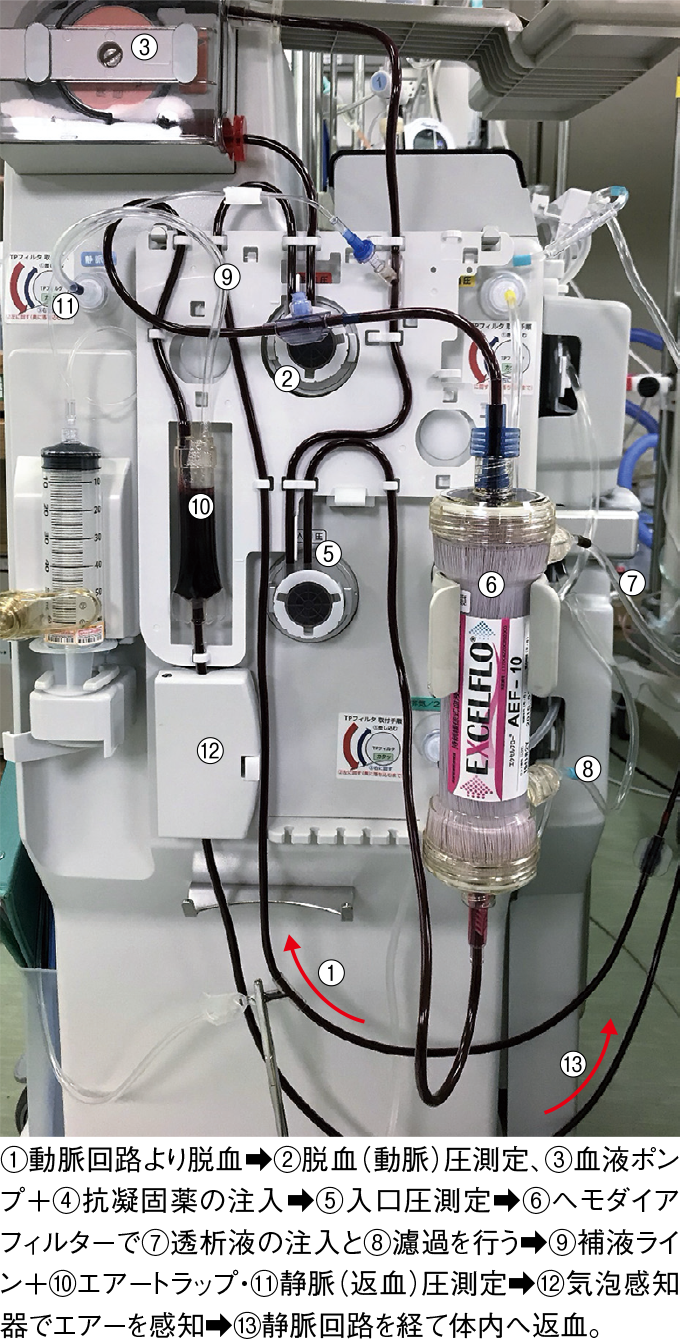 持続的血液濾過透析（CHDF）| ICUでの血液浄化療法 | 看護roo![カンゴルー]