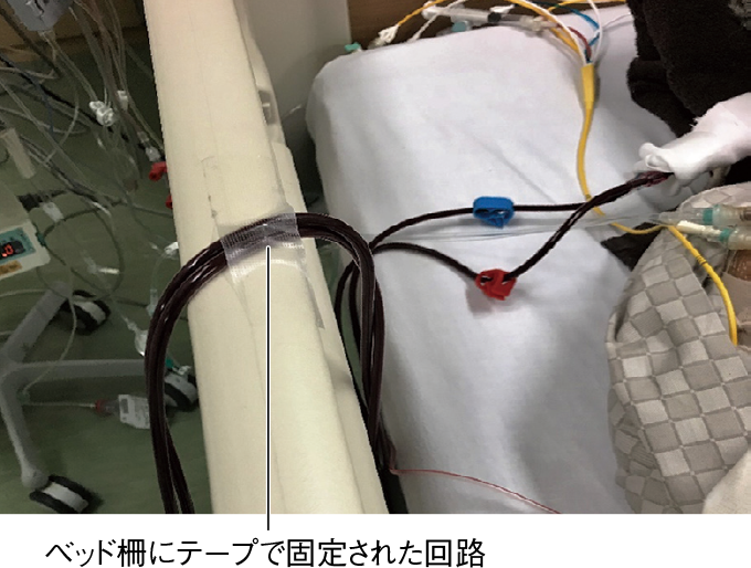 持続的血液濾過透析（CHDF）| ICUでの血液浄化療法 | 看護roo![カンゴルー]