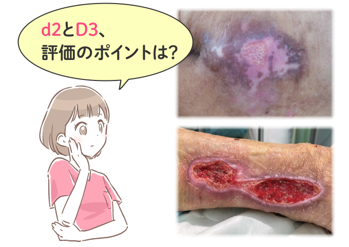 褥瘡セミナー｜看護師のリアルなお悩みにQ&Aで答えるよ【2025年開催】 | 看護roo![カンゴルー]